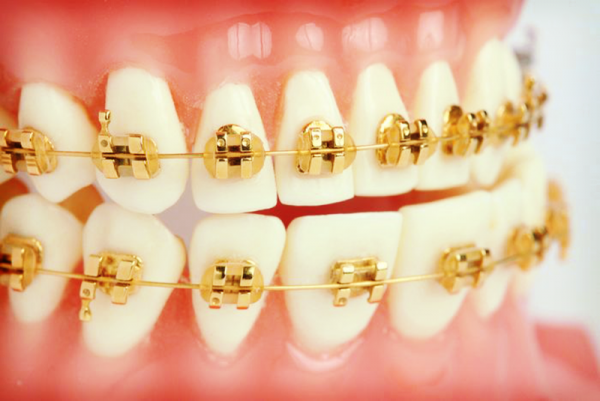 Gold Braces | Hoyt Dental | Murrieta & Temecula Dentist - Orthodontics ...
