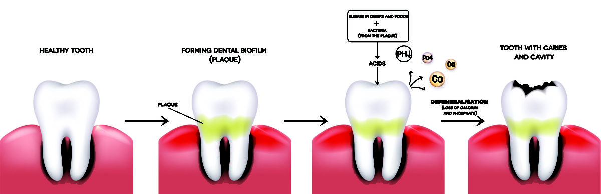 Tooth Decay Eliminated in 15 Minutes | Hoyt Dental | Murrieta ...