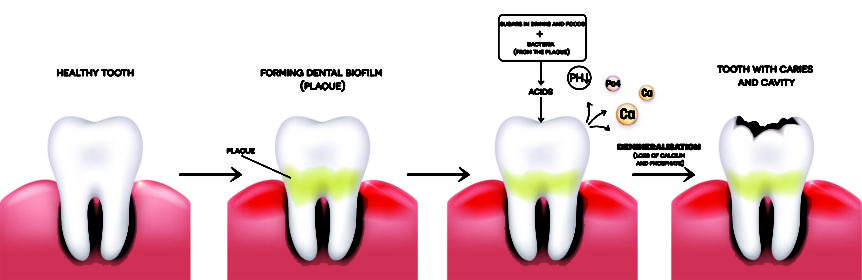 Tooth Decay Eliminated in 15 Minutes | Hoyt Dental | Murrieta ...